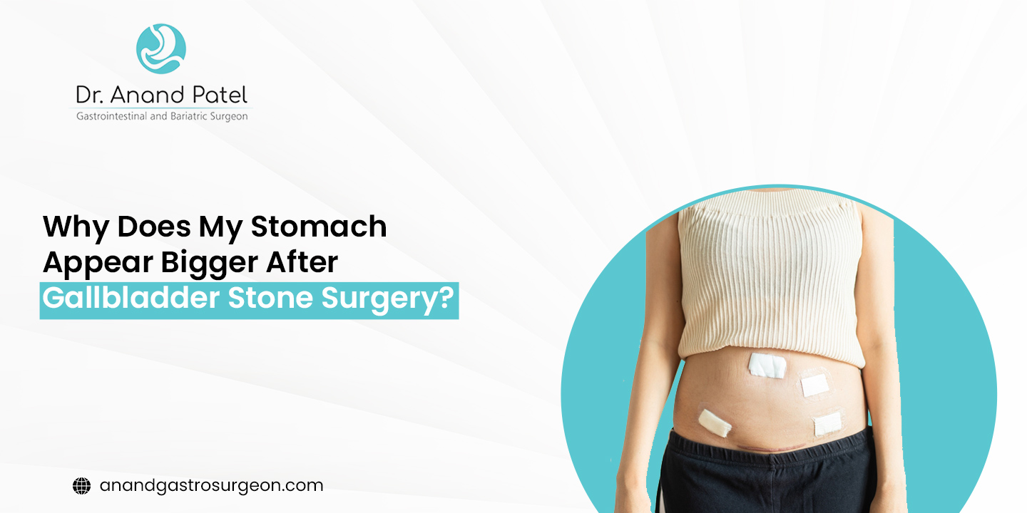 Understanding belly changes after gallbladder stone surgery